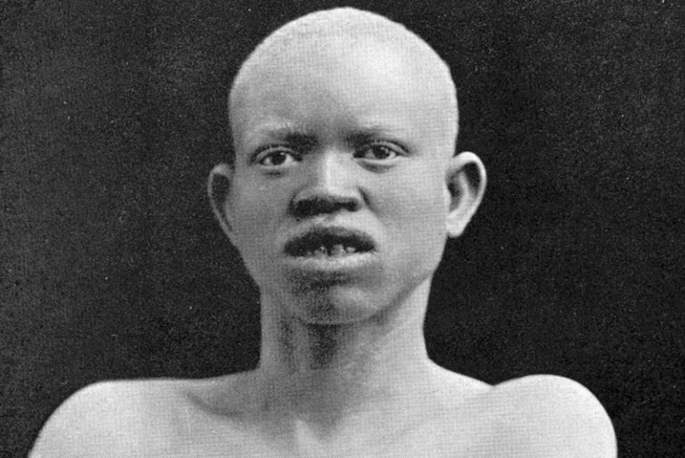 People With Albinism Struggle to Find Their Place in Society—It’s Time ...